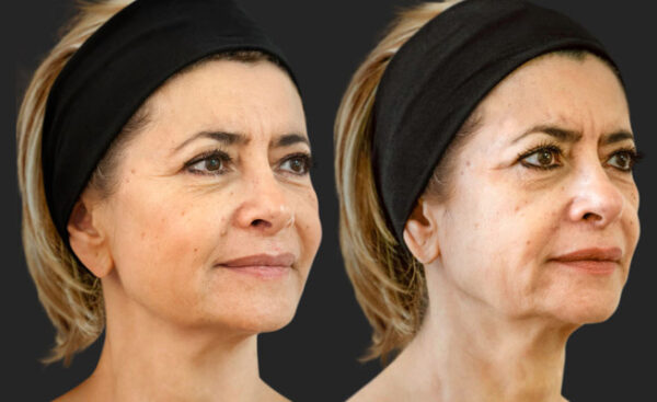 Ellansé Facial Volume - Revive Skin Clinic